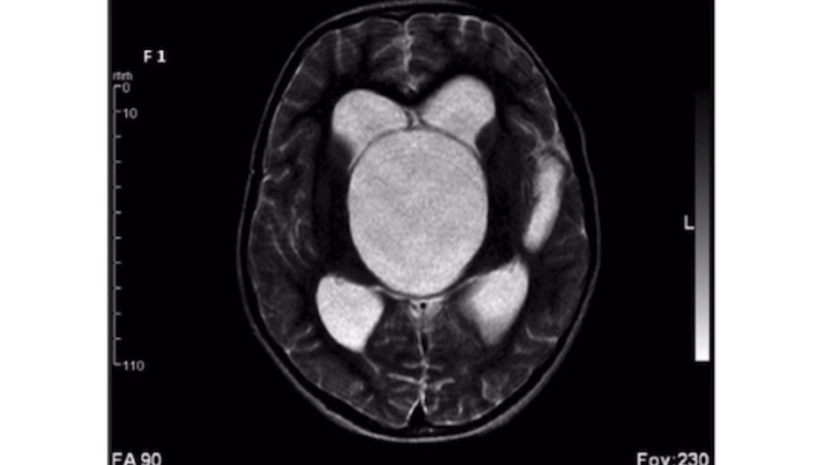 Bobble Head Syndrome In Adults At Marquita Darden Blog