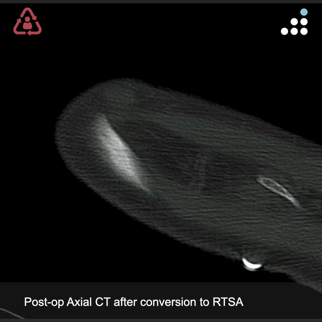 Orthobullets on Twitter: "Post op CT scan after Conversion to RTSA"