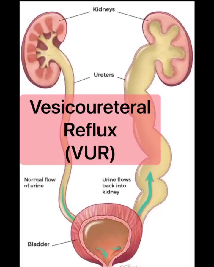 Vesicoureteral Reflux