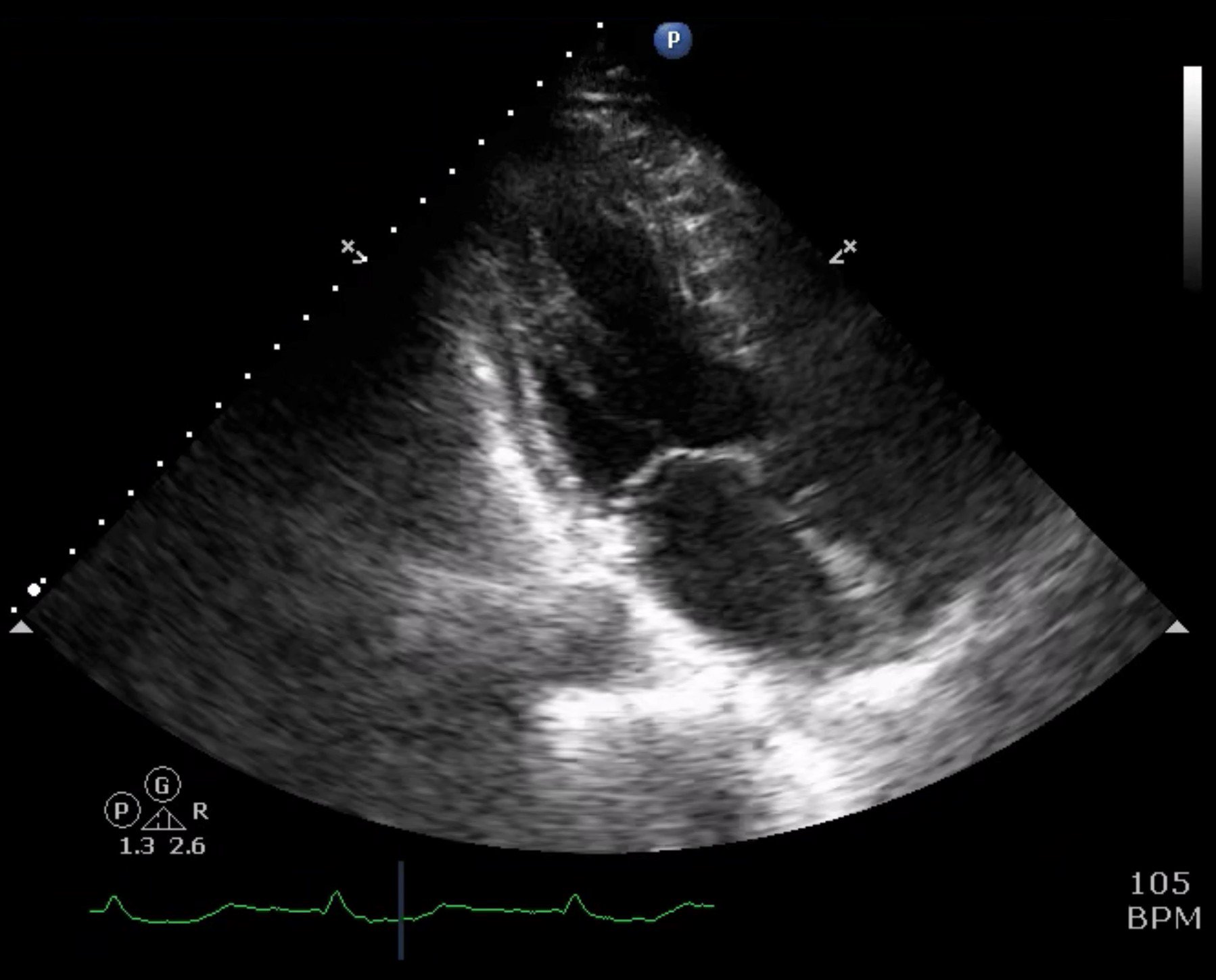 Ashley Miller on Twitter: "Dissection features: 1. DILATATION The anatomy cartoon above includes ...