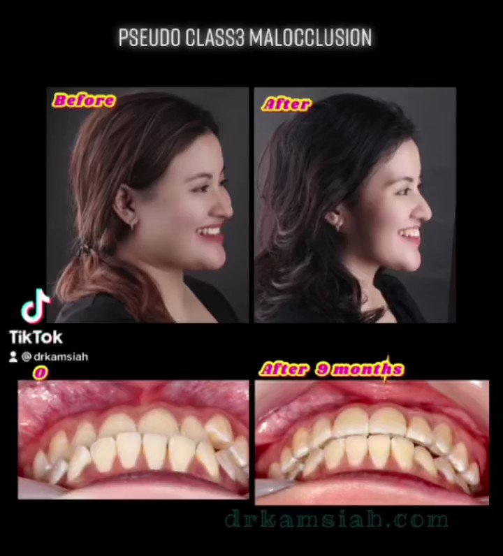 Class 3 Malocclusion