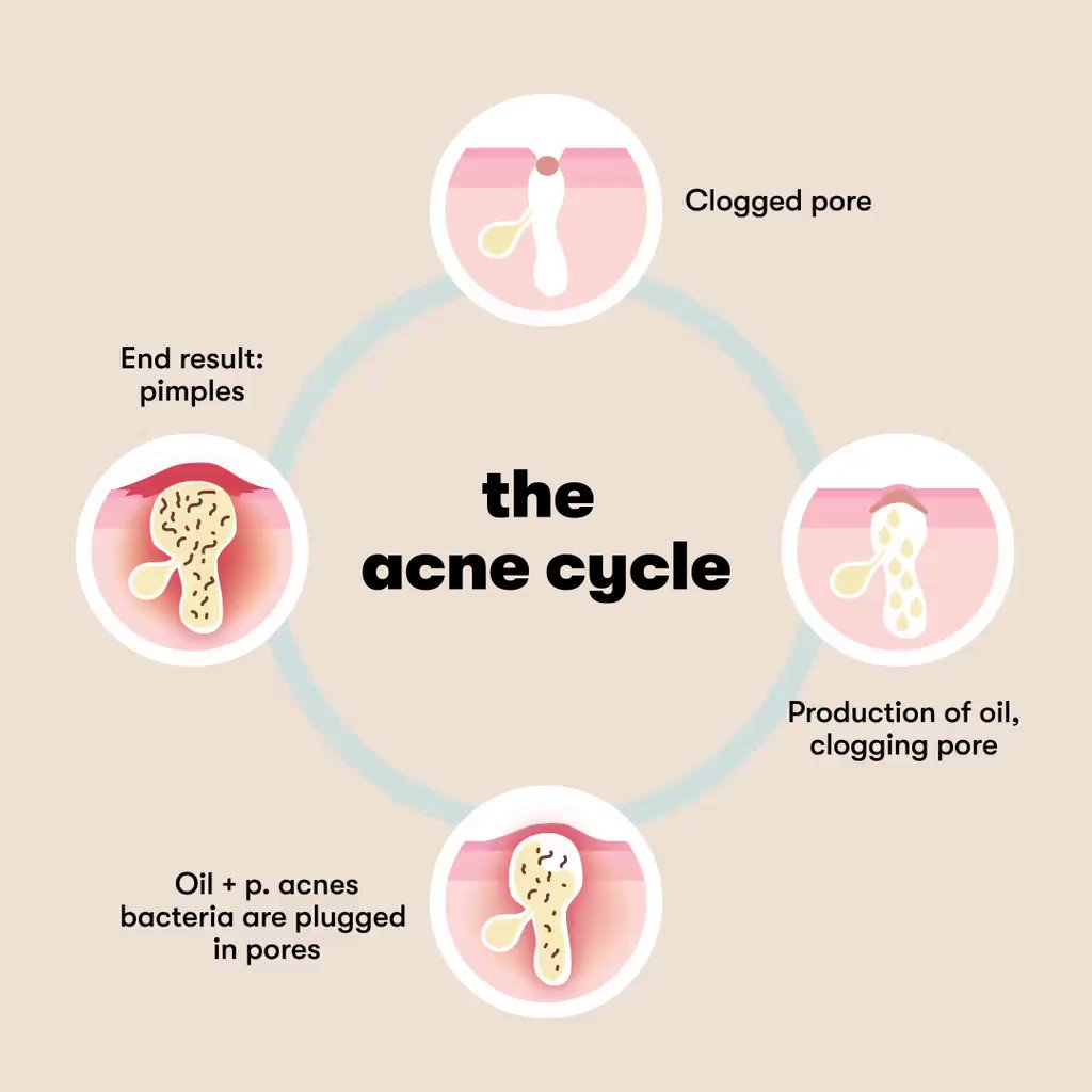 Clogged Pores Diagram