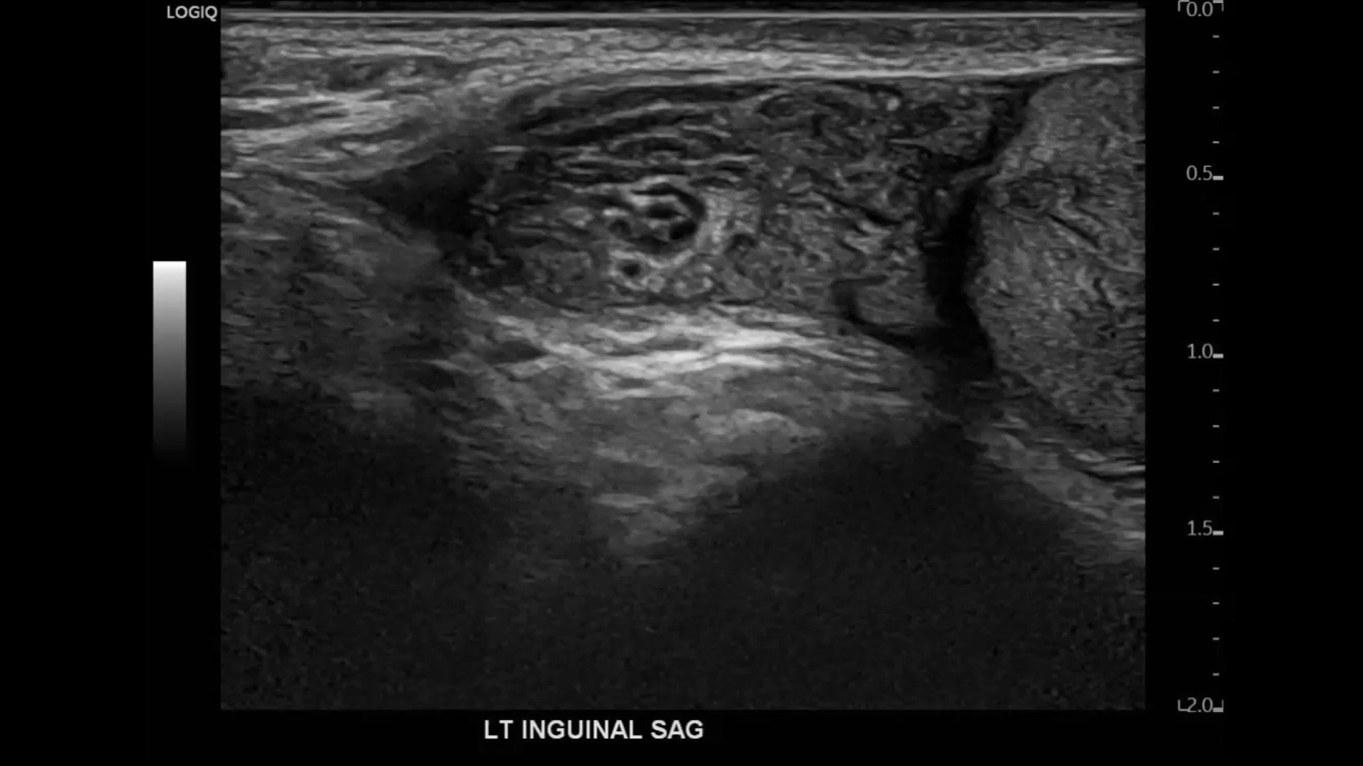 Sonographic Tendencies On Twitter Testicular Torsion With Preserved