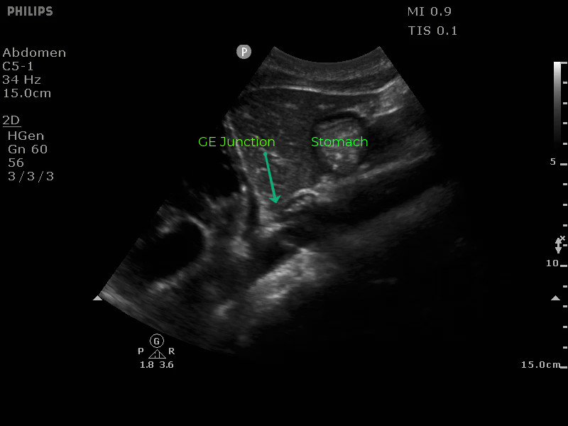 Gastroesophageal Junction Ultrasound