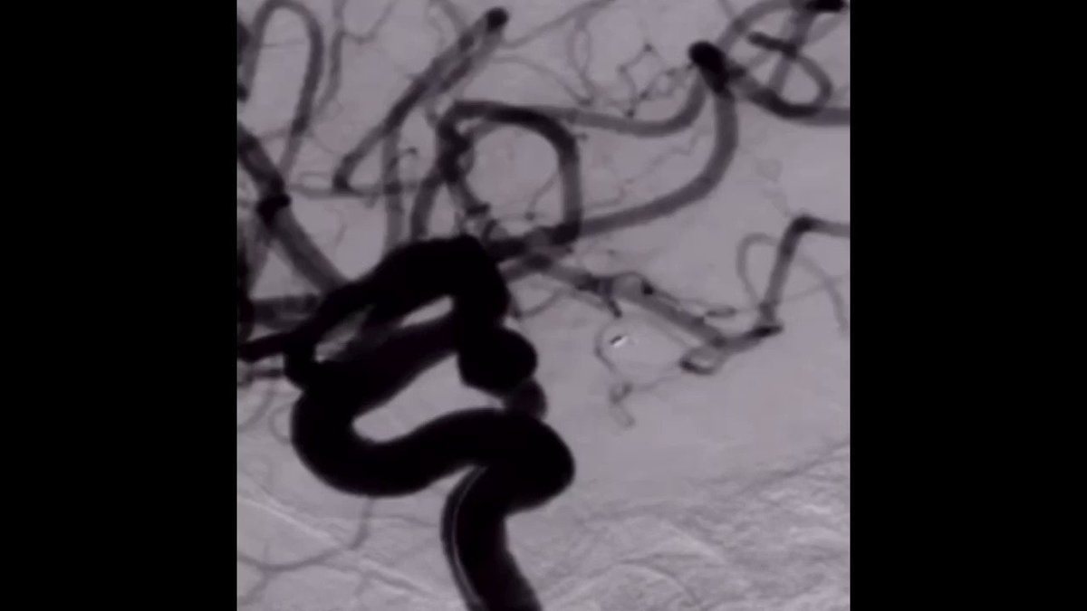 Oren Gottfried Md On Twitter Satisfying To See This Coil Embolization Of Cerebral Pcom Aneurysm