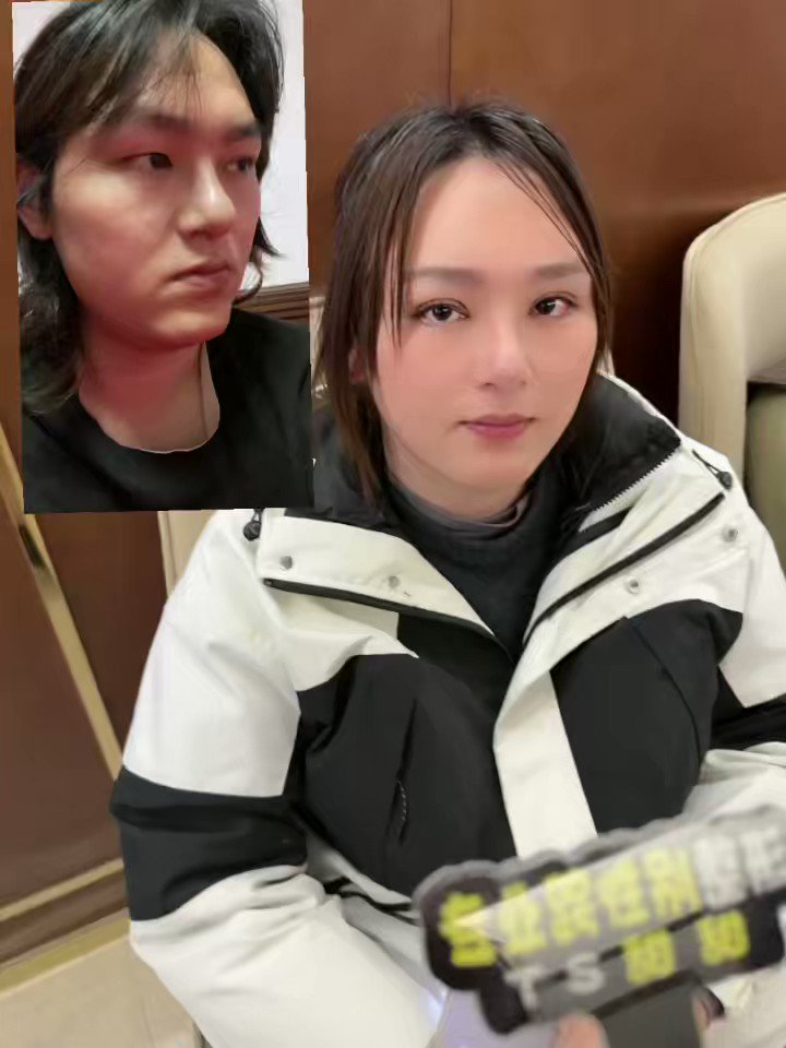 正规资质医院跨性别隆胸面部女性化丰臀抽脂医院 甜甜 On Twitter 姐妹已做项目 眼综合 额头太阳穴填充 瘦脸针 恢复期肿胀中 共花费2万多 转发点赞这条推文截图加微信