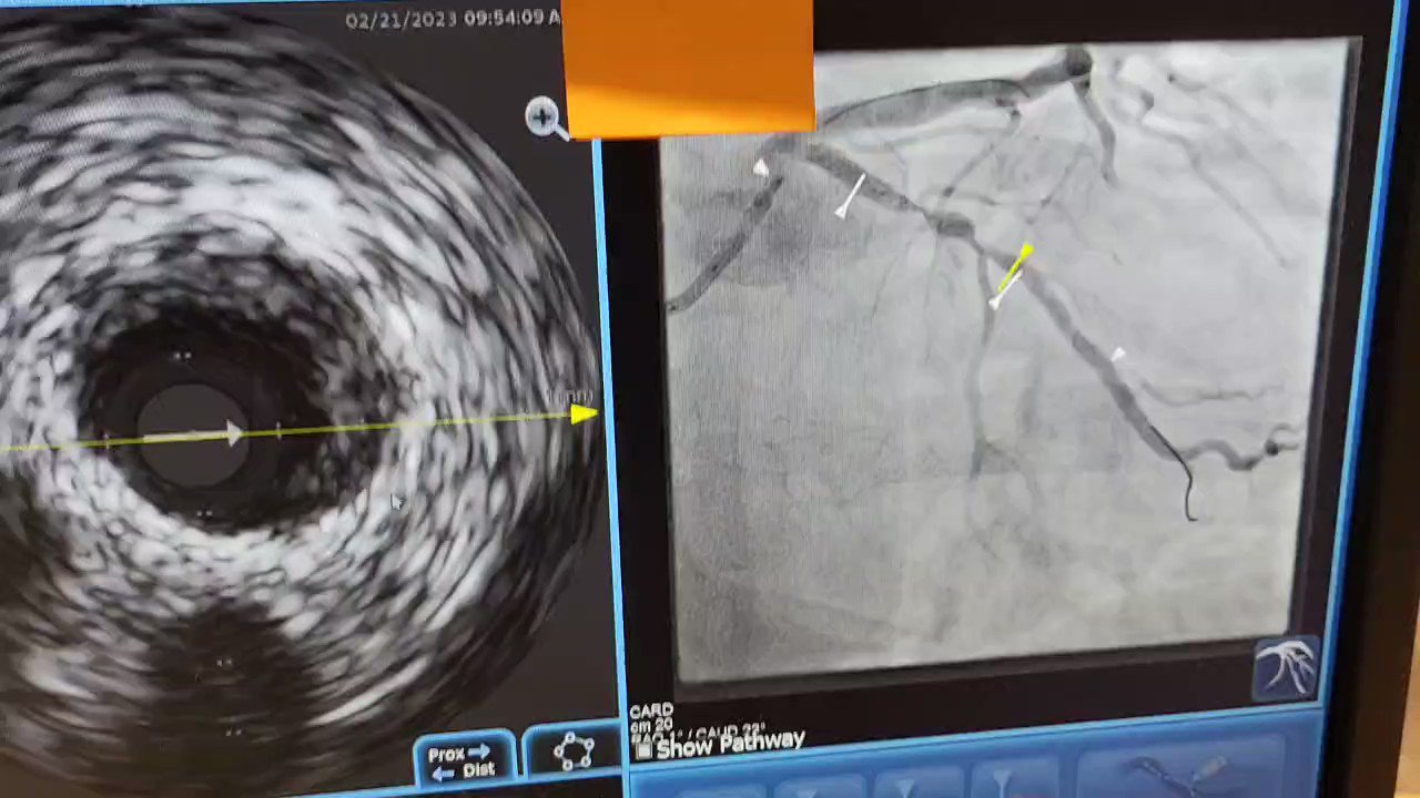 IVUS PCI Daily (@IVUS_PCI_DAILY) / Twitter