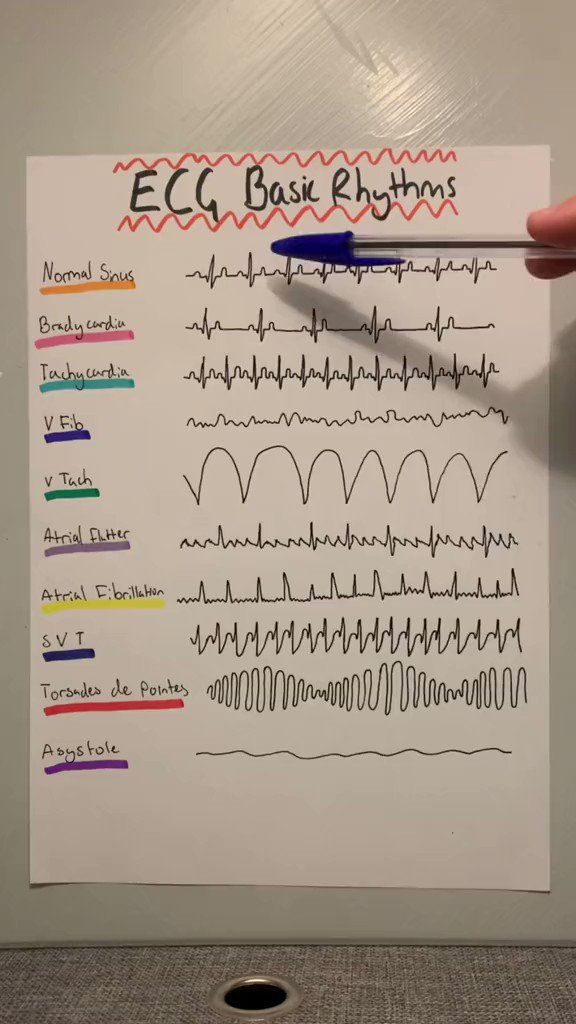 Basic Ekg Rhythms