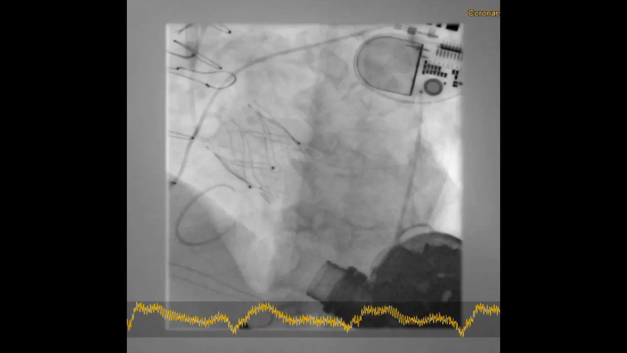 European Society of Cardiology Journals on Twitter: "#TAVR with a dedicated valve system for ...