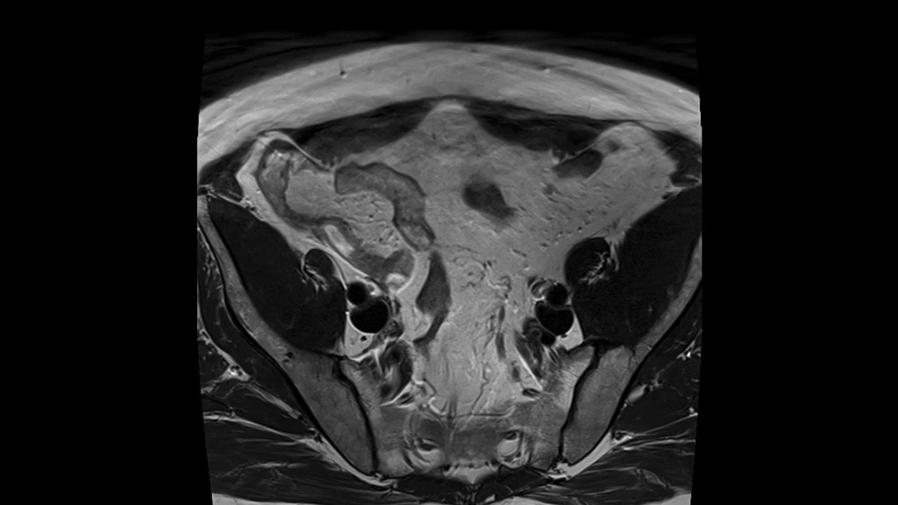 Jonathan A. Hernández Mancera on Twitter: "Patient with history of BCG instillations for bladder ...