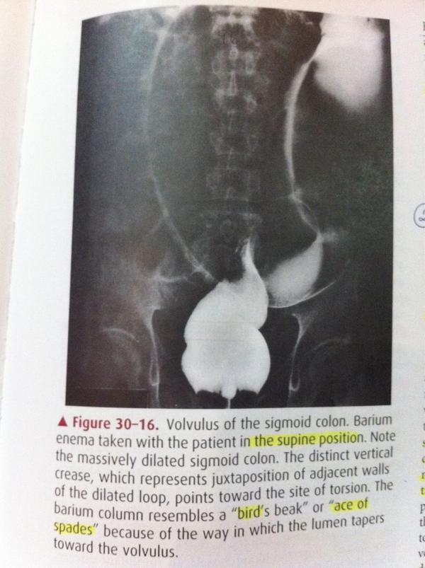 Sigmoid Volvulus Birds Beak