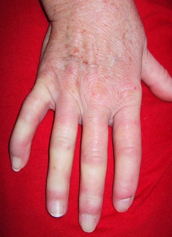 Scleroderma Skin Rash