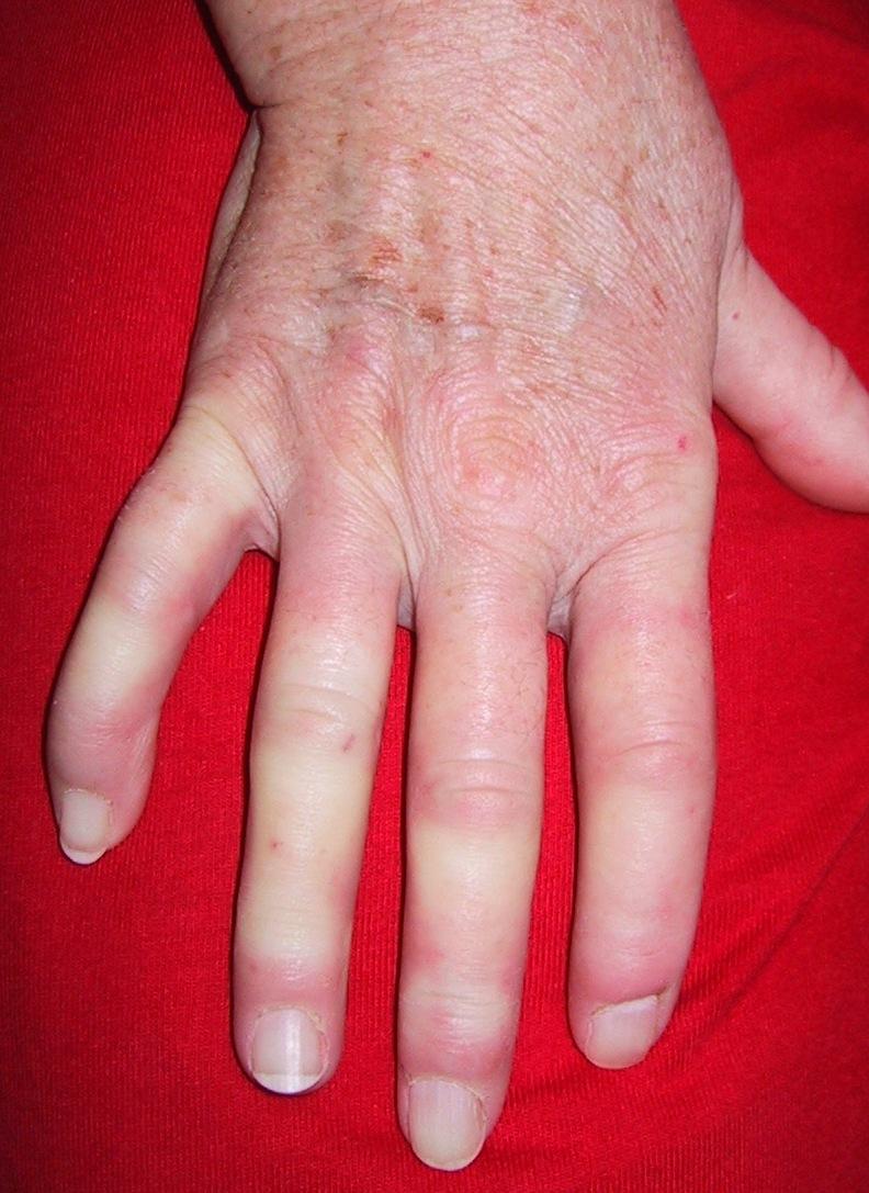 Erythema Hands
