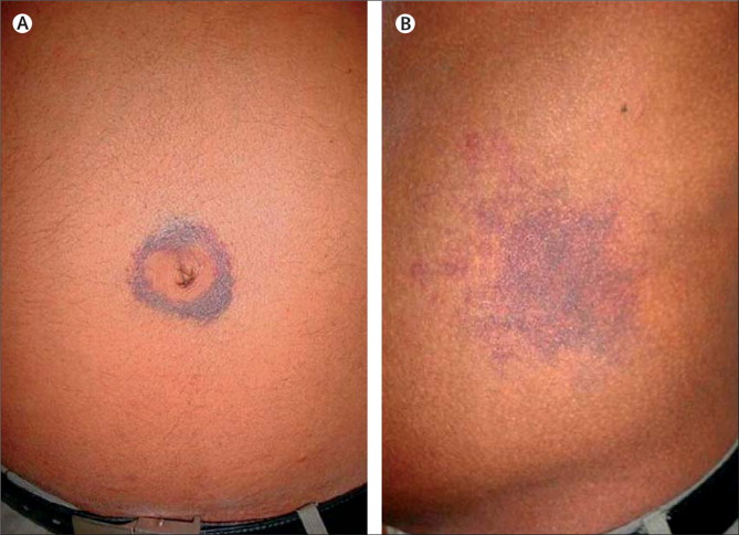 Sinal De Turner Cinza Pancreatite