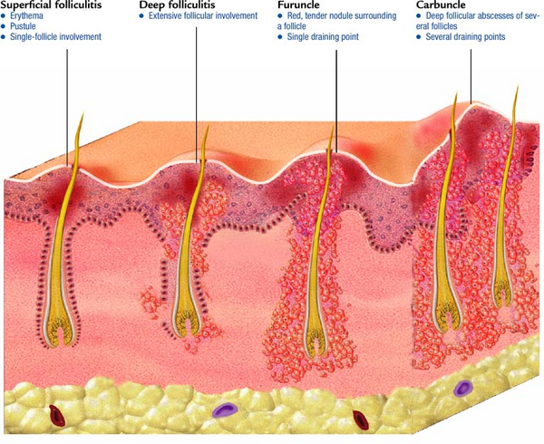 Furuncle Vs Carbuncle
