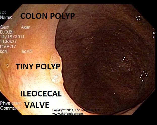 Ileocecal Valve Polyp