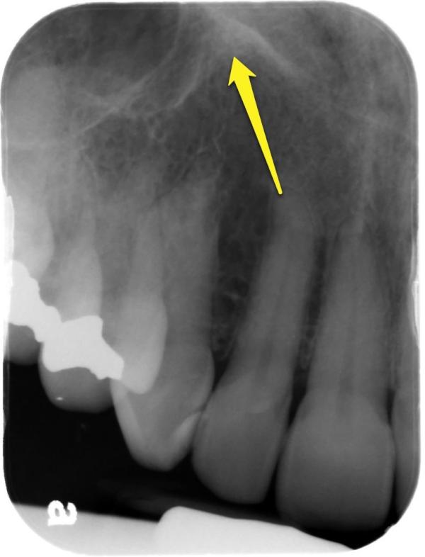 Floor Of The Nasal Cavity Radiograph