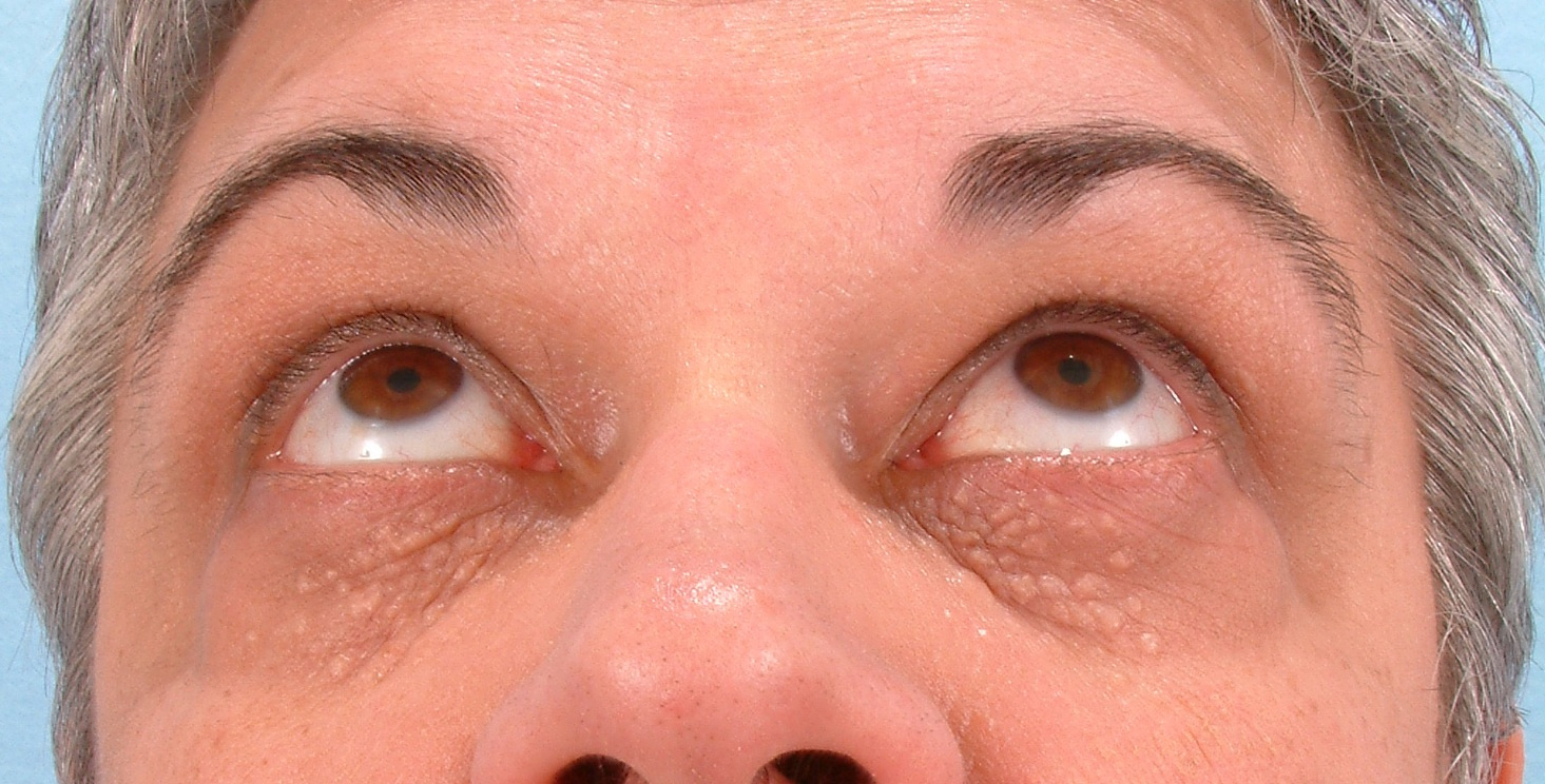 Xanthelasma Causes