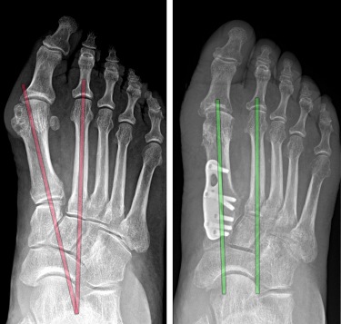 Lapidus Bunionectomy
