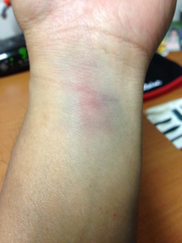 Bruise On Wrist