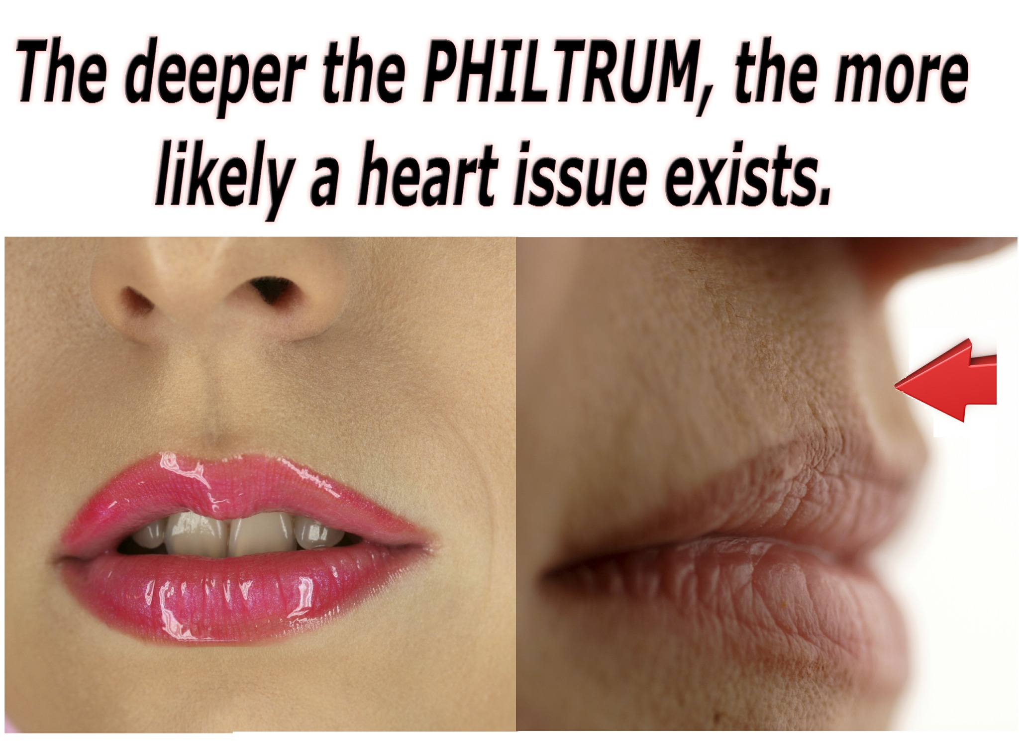 Philtrum Of Lip