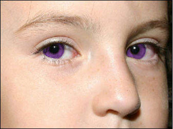 Albino Purple Eyes