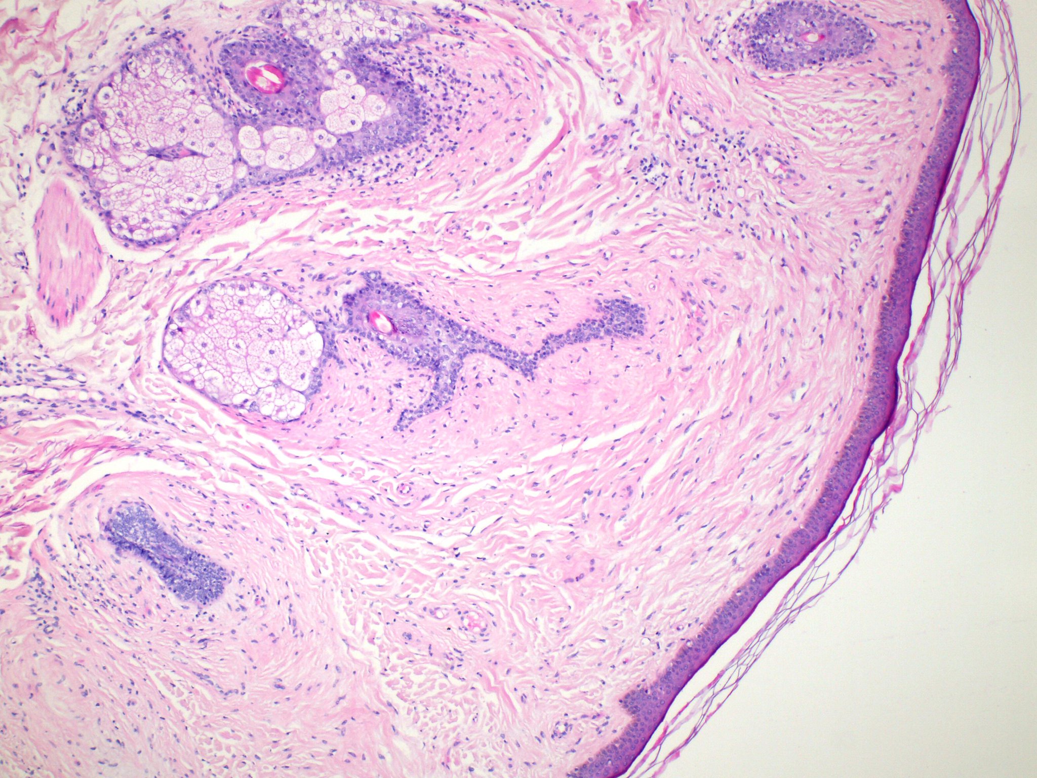 Jerad Gardner, MD on Twitter: "“@DOC_MEK: 42yo M Neck, nose-white/skin-colored papules (>100). # ...