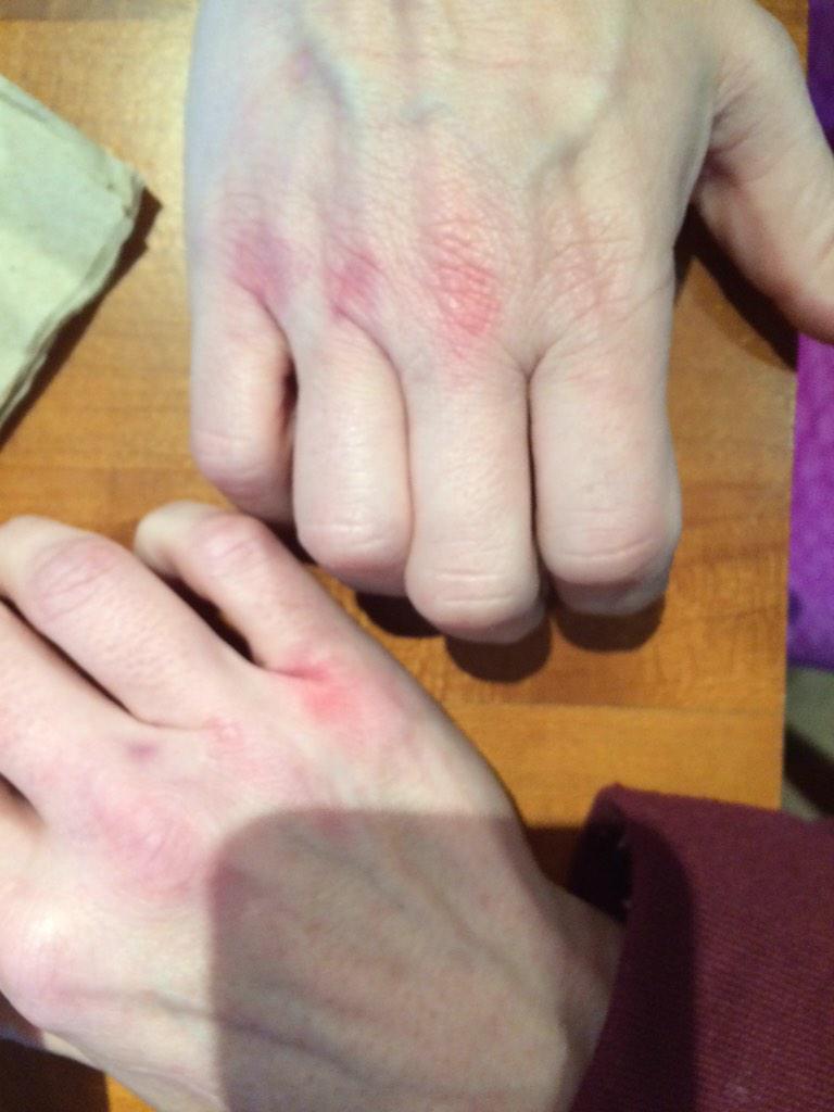 Bruised Knuckles