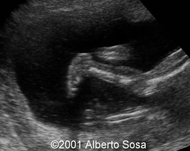 Rocker Bottom Feet Trisomy 18