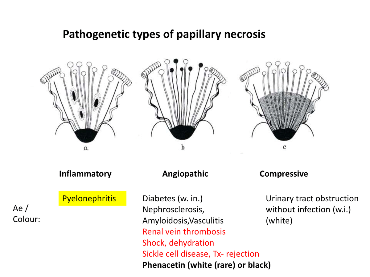 Renal Papillary Necrosis Histology