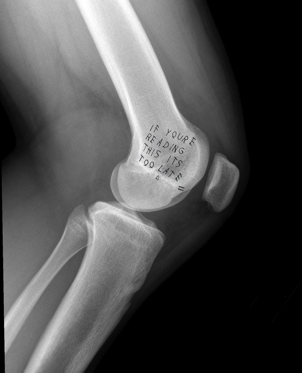 Derrick Rose Acl X Ray Surgery | Biomechanics In The Wild
