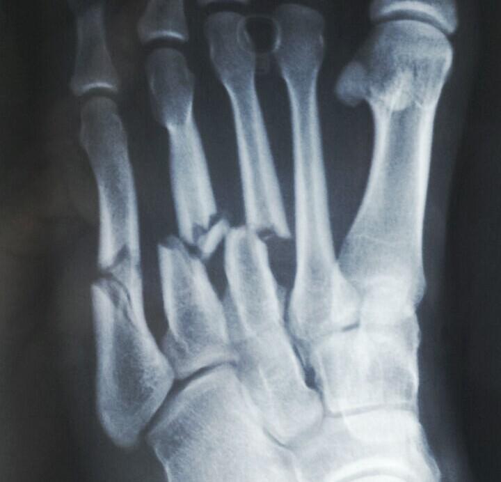 Xray Of Broken Foot