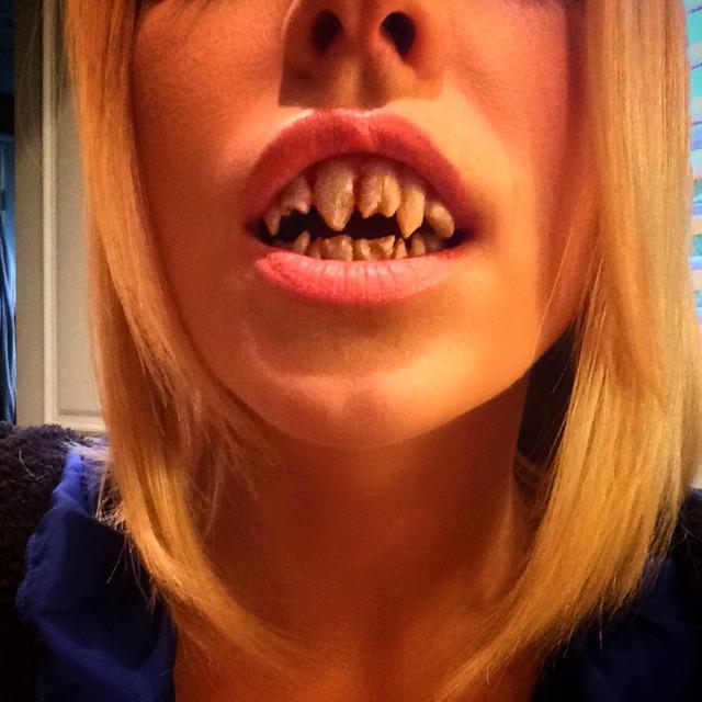 Sharpened Canine Teeth