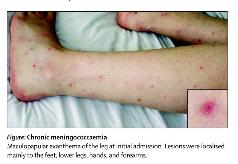 Neisseria Meningitidis Rash