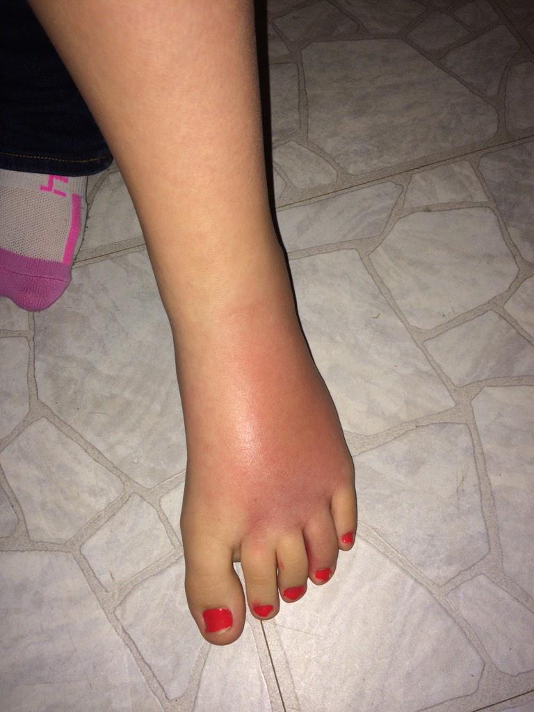 Wasp Sting Swollen Toe