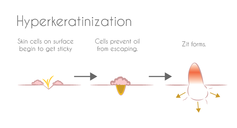 Hyperkeratinization Acne