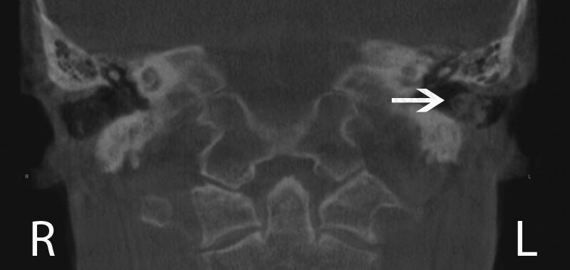 External Auditory Meatus X Ray