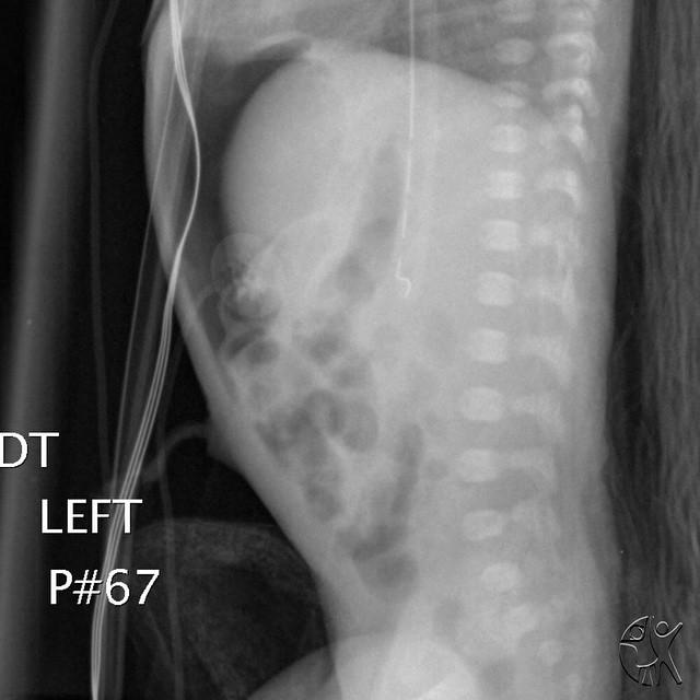 Cross Table Lateral X Ray