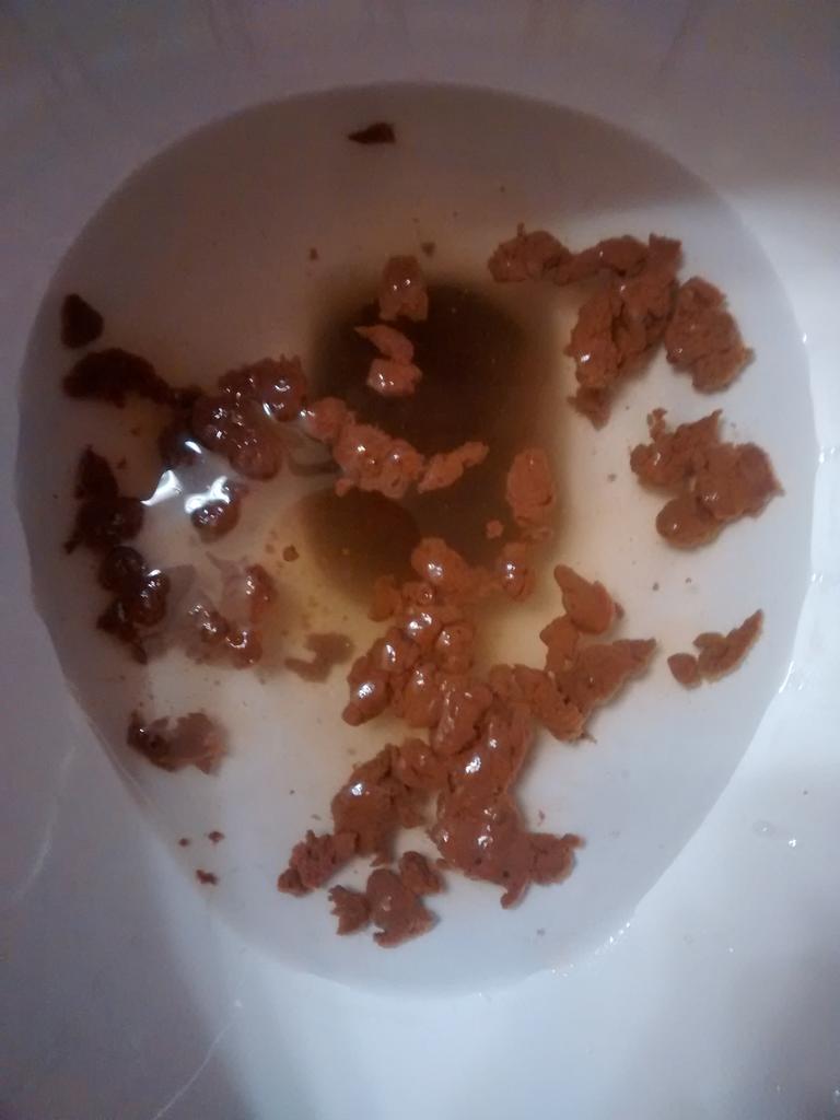 Oily Poop Stool Color, Shape And Self Diagnosis | Samitivej Hospital,