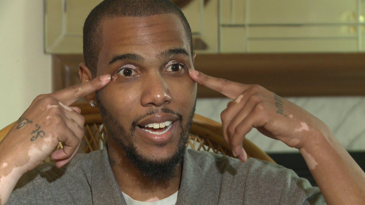 Michael Jackson: It's the same skin disease Michael Jackson had