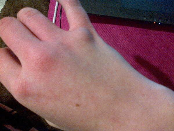 Bruised Knuckles From Punching A Wall