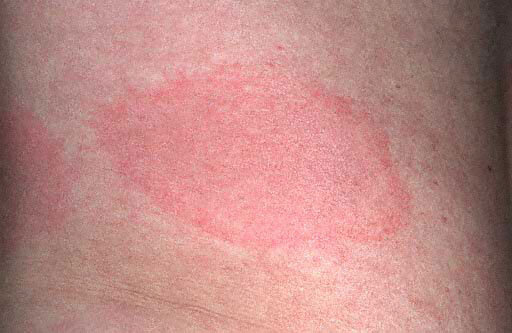 Eritema Migratorio Lima