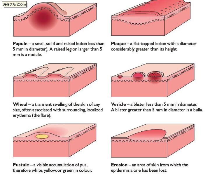 Wheal Skin Lesion