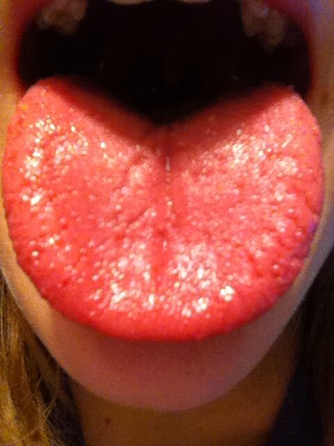 Taste Buds On Tongue Are Swollen Spacotin