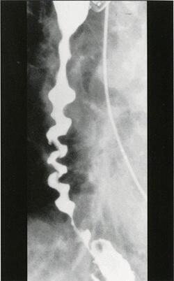 Diffuse Esophageal Spasm Barium Swallow