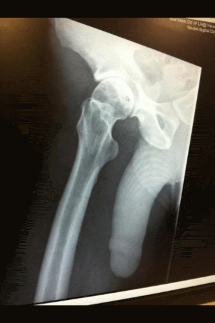 Bad Broken Bone X Ray
