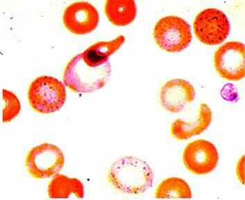 Lead Poisoning Smear