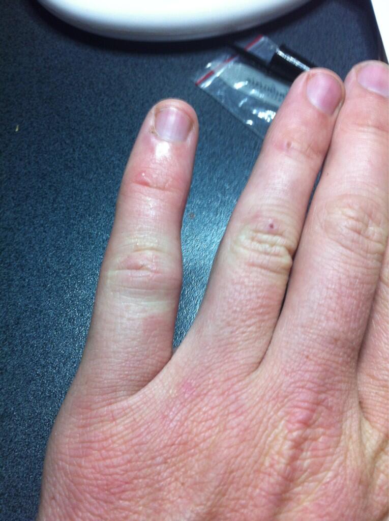 Dislocated Knuckle
