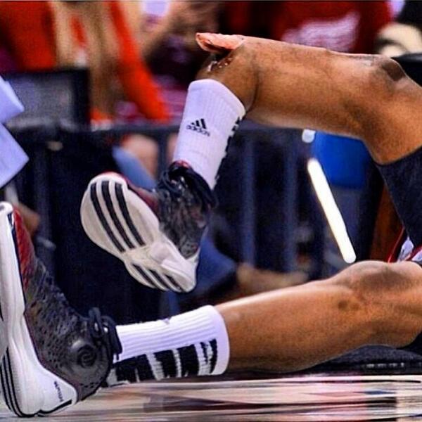 Kevin Ware Injury Close Up