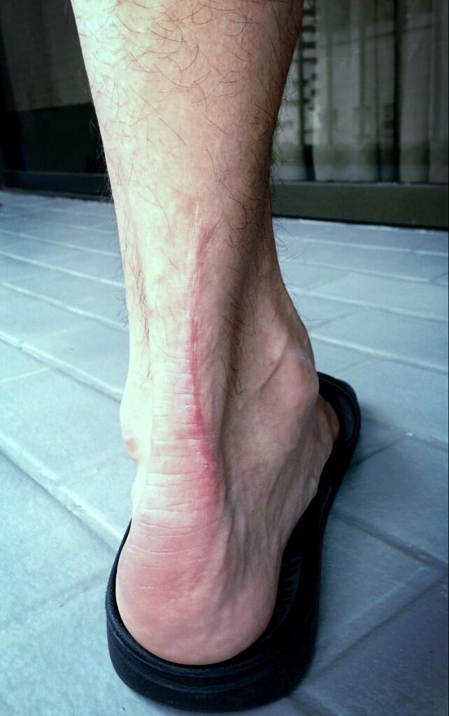 Torn Achilles Scar